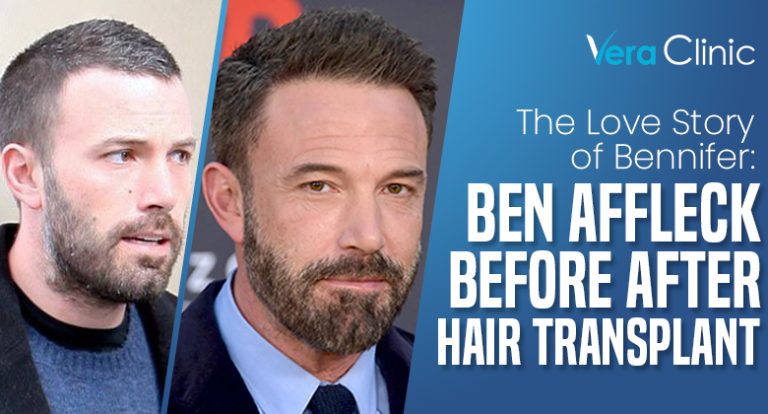 The Love Story of Bennifer: Ben Affleck Before After Hair Transplant ...