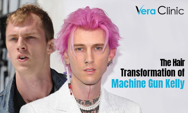 Machine Gun Kelly Hair Transplant - Vera Clinic