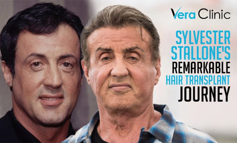 Sylvester Stallone Hair Transplant - Vera Clinic