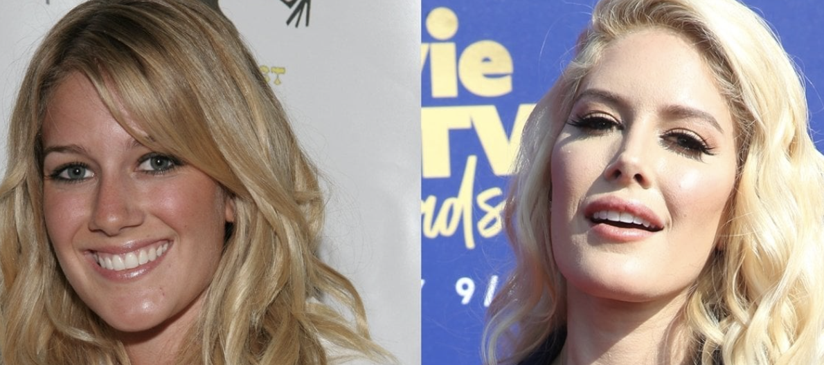 Heidi Montag Plastic Surgery: A Transformation Journey