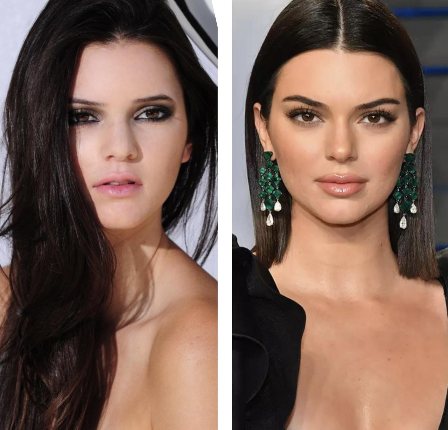 Kendall Jenner Plastic Surgery Journey: Exploring the Rumors and Realities