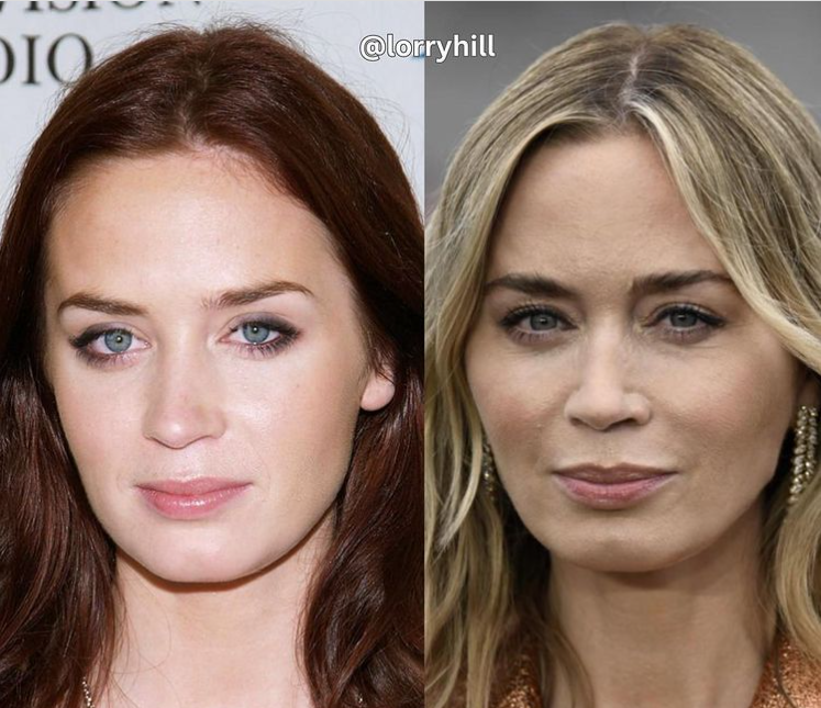 Emily Blunt Plastic Surgery: Fact or Fiction?