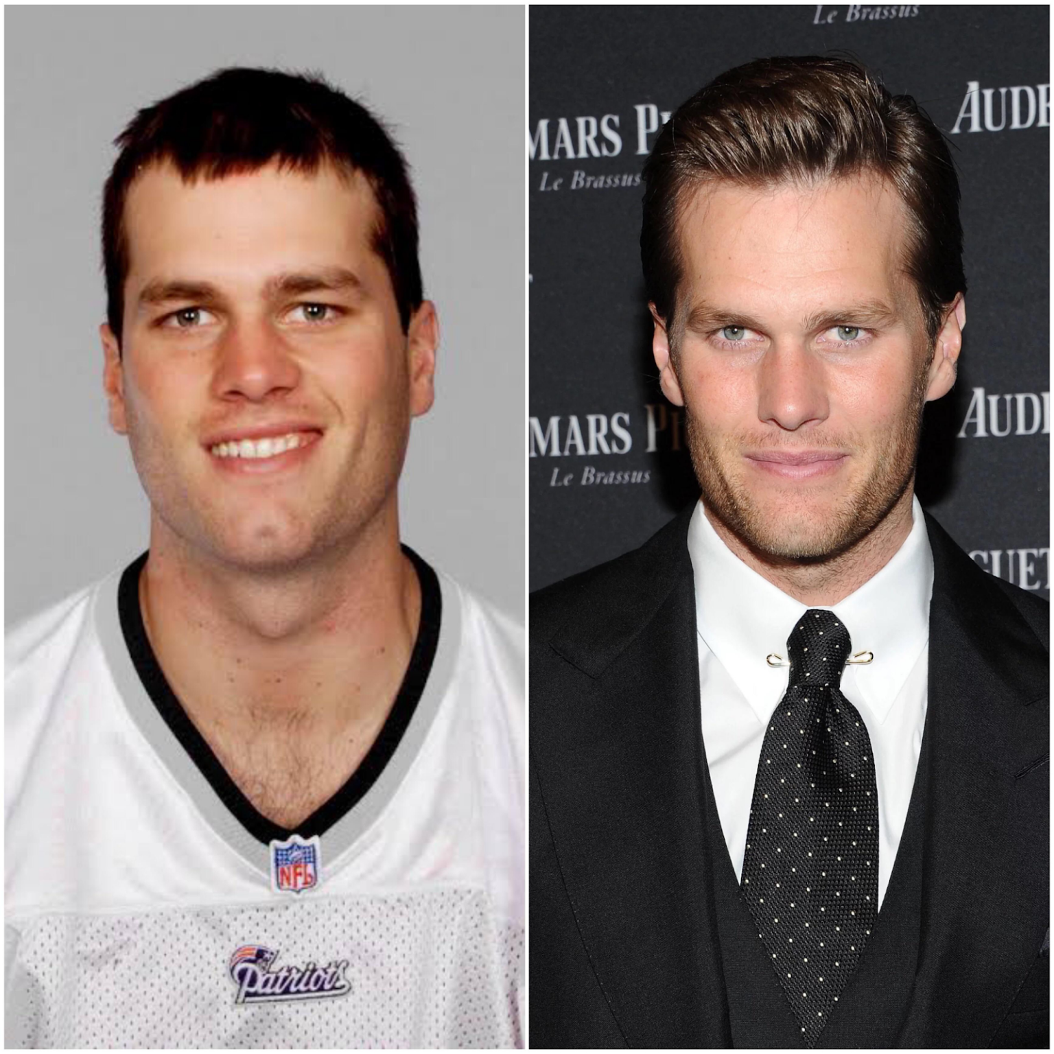Tom Brady Plastic Surgery: Explore All the Rumors