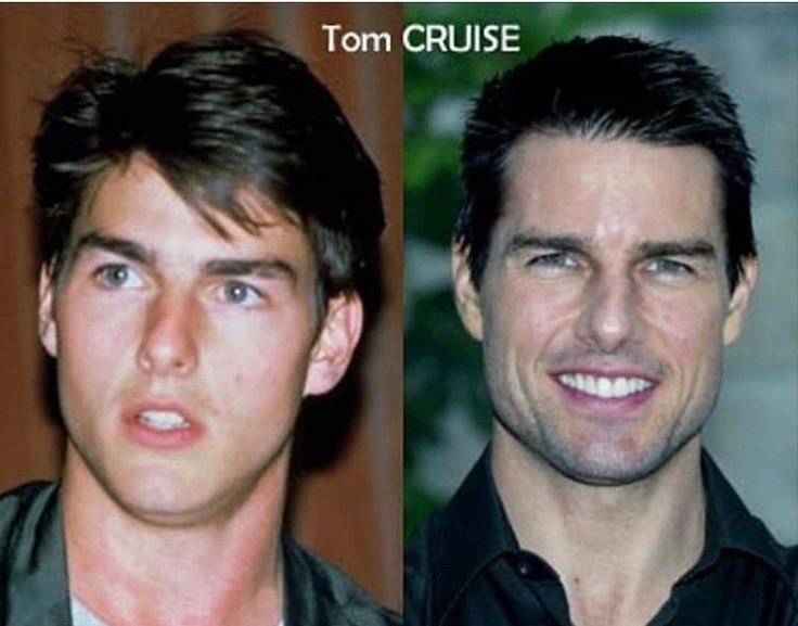 Tom Cruise Plastic Surgery: Exploring the Mystery