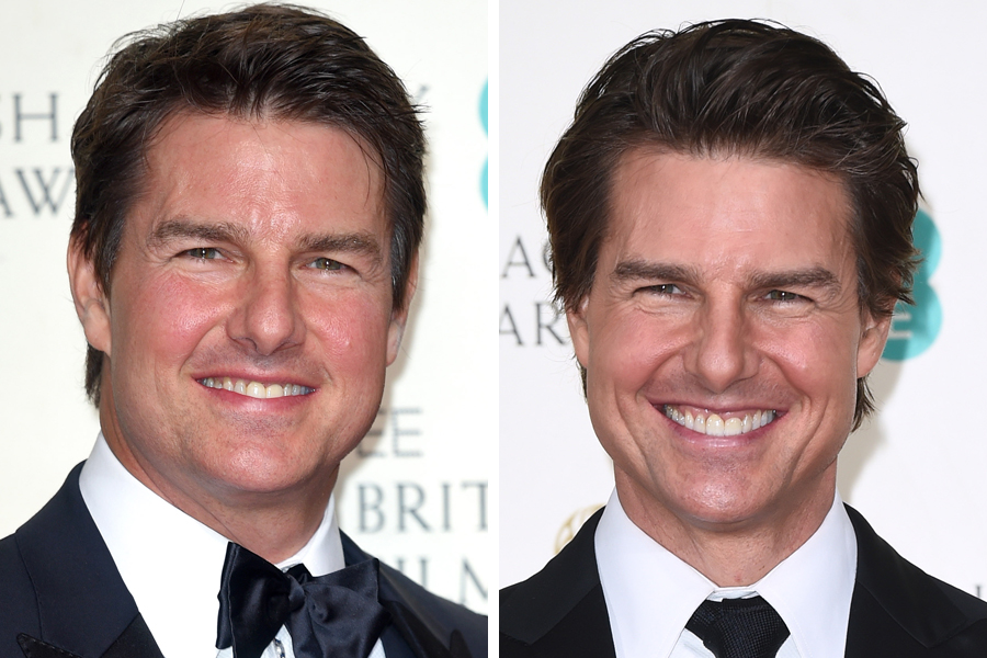 Tom Cruise Plastic Surgery: Exploring the Mystery