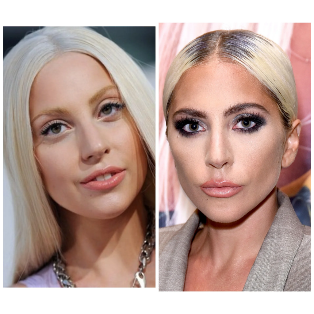 Lady Gaga Plastic Surgery: Unveiling the Transformation