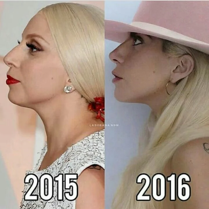 Lady Gaga Plastic Surgery: Unveiling the Transformation