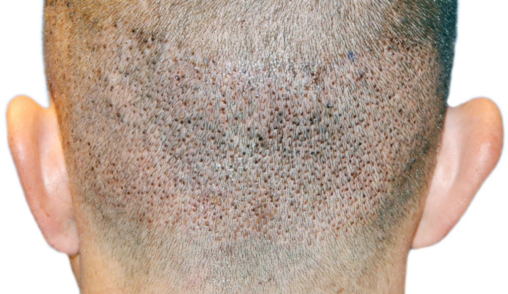 Heilungsverlauf nach Haartransplantation: Eine umfassende Übersicht - VeraClinic