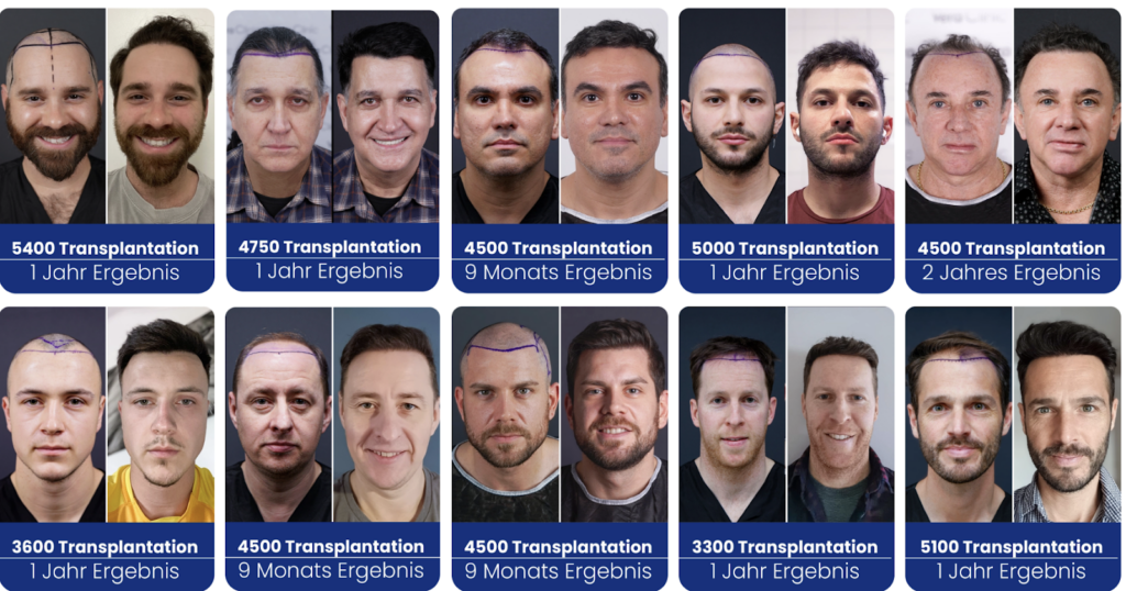 Heilungsverlauf nach Haartransplantation: Eine umfassende Übersicht - VeraClinic