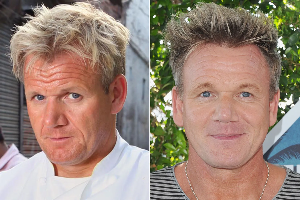 Gordon Ramsay Plastic Surgery: A Close Look Before and After