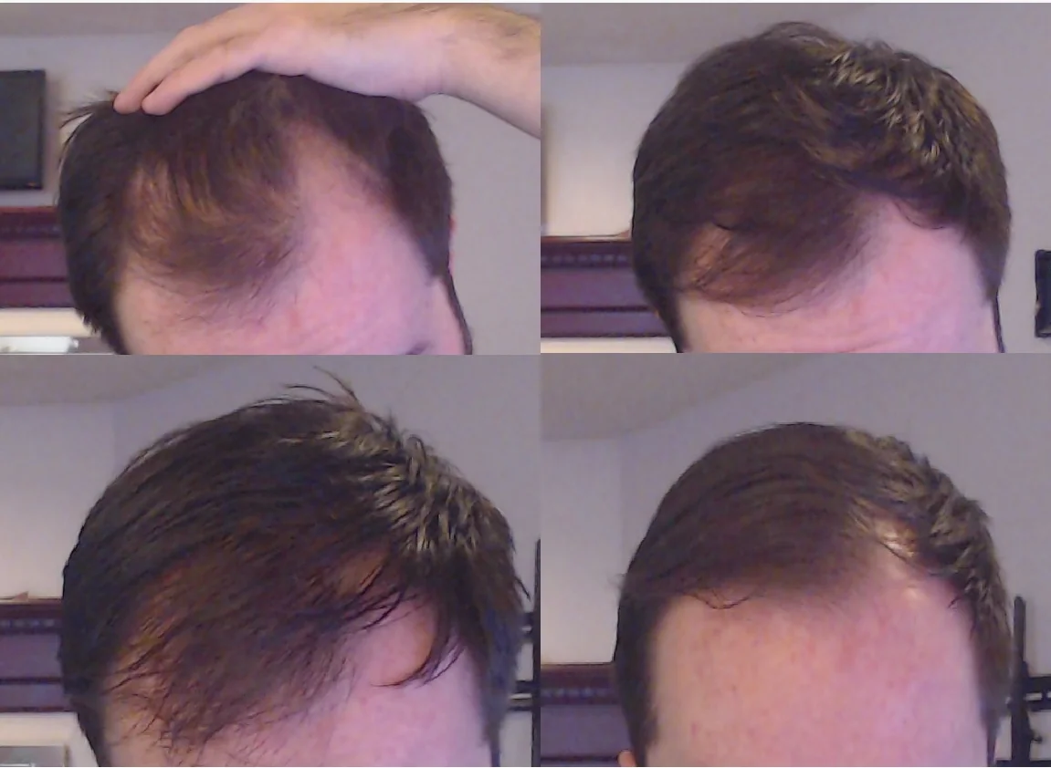 Maturing Hairline: What Is the Difference Receding Hairline?